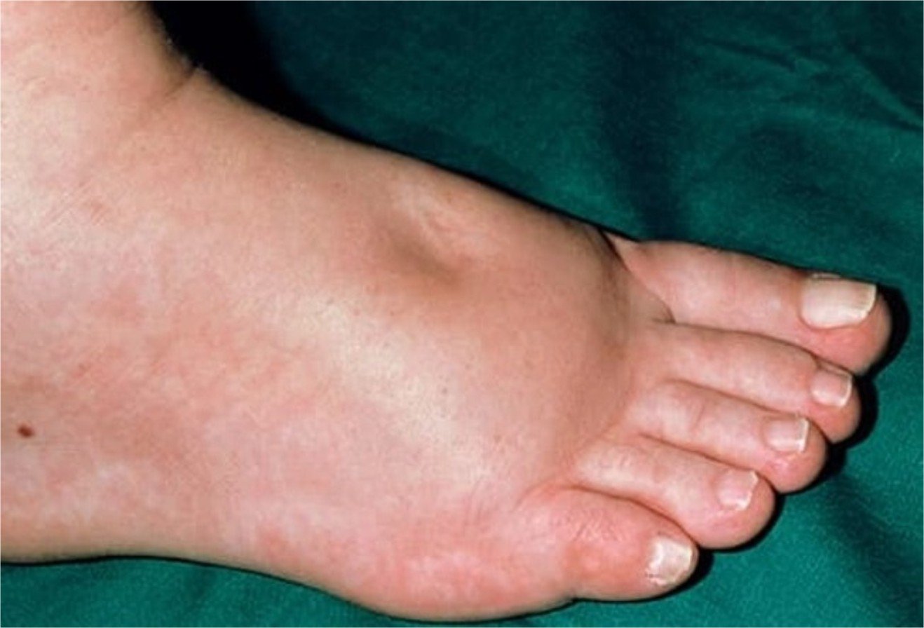 Major Causes Of Swollen Feet